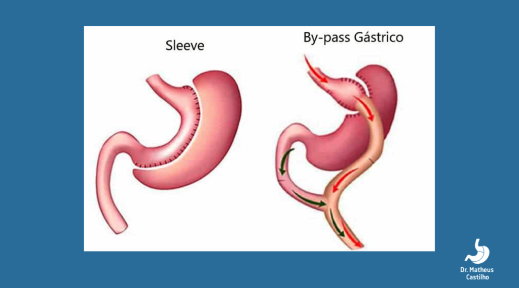 Bypass ou Sleeve, qual a melhor opção para mim? Entenda as Escolhas na ...